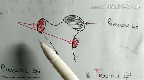 Type Of Epiphysis Basic Anatomy Of Bone Youtube