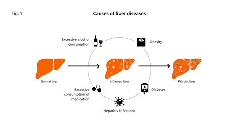 Liver Fibrosis Patients Can Be At Risk Of Death Even Without