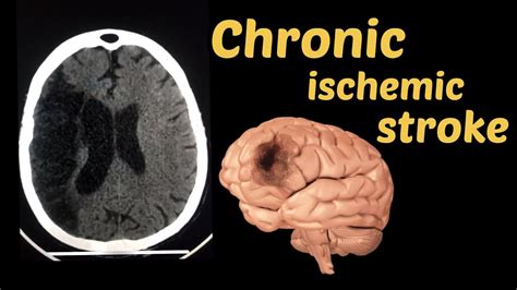 Mca Territory Chronic Ischemic Infarct Ct Brain Radiology Stroke Ctscan Shorts Youtube