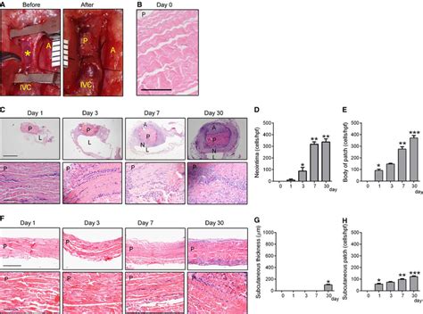 Increased Cell Infiltration After Patch Venoplasty A Operative