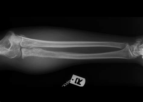 Osteosarcoma Sunburst