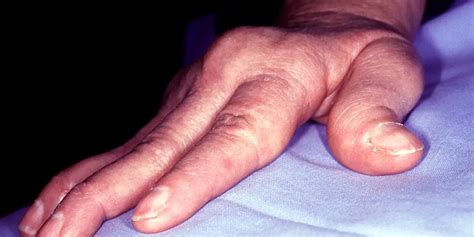 Swan Neck Deformity Symptoms Causes And Treatment