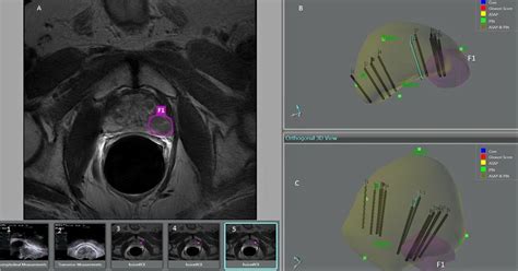 Multiparametric Mri Trus Fusion Guided Biopsy In A 62 Year Old Male Download Scientific
