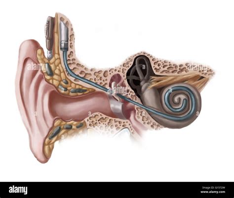 Cochlear Implant Deaf Cut Out Stock Images And Pictures Alamy