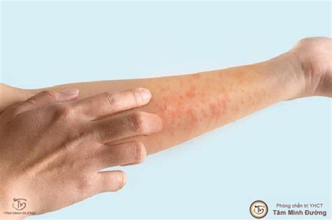 Men Gan Cao Là Gì Có Nguy Hiểm Không Dấu Hiệu Và Điều Trị