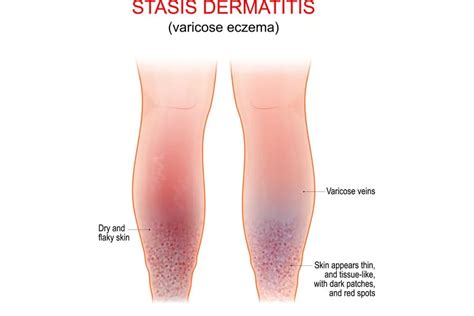Venous Stasis Causes Symptoms And Preventative Measures Longmore Clinic