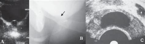 Midline Intraprostatic Cyst An Unusual Cause Of Lower Urinary Tract