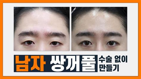 남자인데 쌍꺼풀 수술은 하기 싫고 눈은 작아서 커지고 싶다면 [히트성형외과 남자이마거상편] Youtube