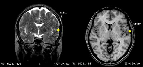 Mri Overlay Of Single Dipole Localization Of Dæ Mismatch Field 190ms