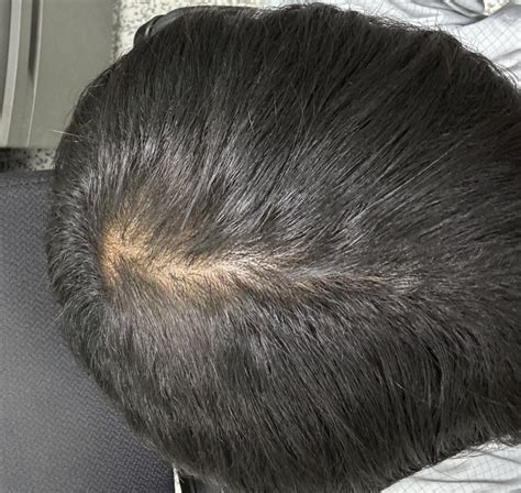 정수리 탈모 피나 1년 9개월 복용 후기 탈모 갤러리 정수리 탈모 피나 1년 9개월 복용 후기 탈모 갤러리