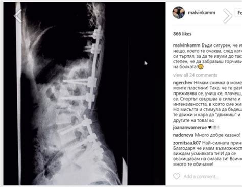 Цвети Стоянова показа рентгенова снимка на гръбнака си СНИМКА Nova