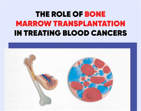 Bone Marrow Transplant Leukemia