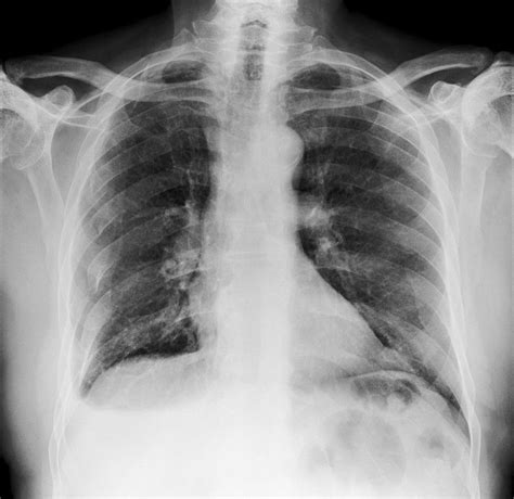 Imagerib Fractures Msd Manual Professional Edition