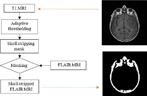 Figure 4 From Automatic Brain Tumor Detection And Volume Estimation In Multimodal Mri Scans Via