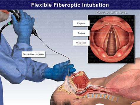 Flexible Fiberoptic Intubation Trialquest Inc