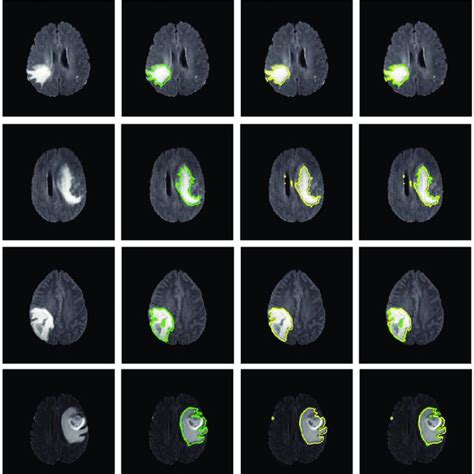 Whole Glioma Brain Tumor Segmentation On Mri Brats2017 Dataset 50 Download Scientific
