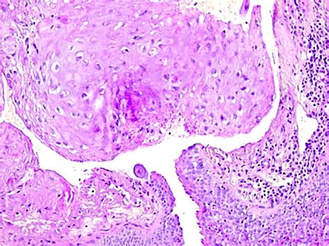 Atypical Chondrocytes With Intracytoplasmic Inclusions Invading The Download Scientific