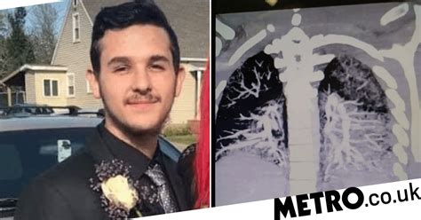 X Ray Shows How Vaping Left Teens Lungs Caked With Hardened Oil Metro News