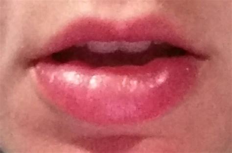 Actinic Cheilitis Treatment In Naples Fl — Naples Dermatology