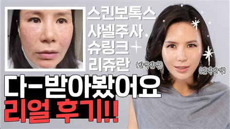 연예인주사 스킨보톡스샤넬주사리쥬란슈링크를 한번에 동시 시술 레알후기 Youtube