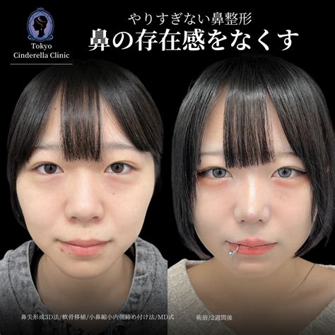 小鼻×鼻先】垢抜けさせる鼻整形 」に関する美容整形の症例写真の詳細 東京シンデレラ美容外科 新宿 池袋 大宮