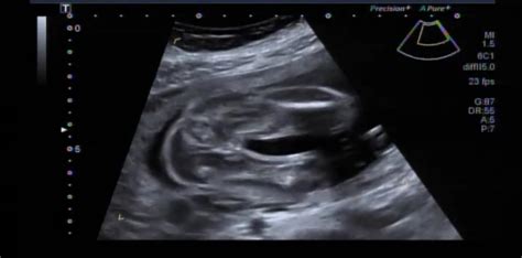 Dra Esqueceu De Anotar O Sexo No Usg Babycenter