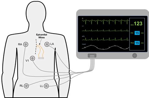 Display Of The Surface And Atrial Electrogram Atrial Electrogram Education Uw Madison