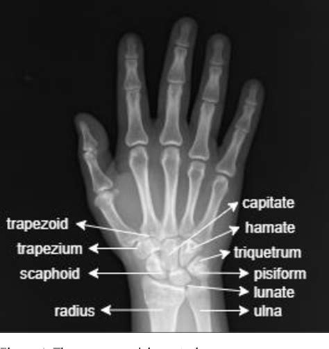 Fracture Detection In Wrist X Ray Images Using Deep Learning Based