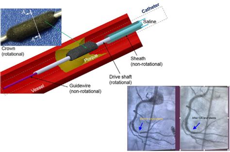 Orbital Atherectomy Dr Refai Showkathali