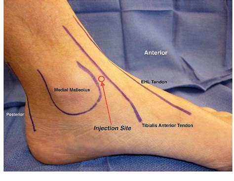 Bone Fracture Hematoma At Robert Sandoval Blog