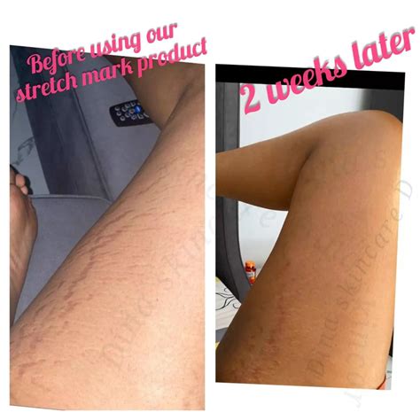 Skindna4u 피부노화주범 3 자외선손상 색소침착 햇빛은 자외선 가시광선 적외선 등으로 구성되는데 그 중 자외선은 피부 색소침착이나 피부세포 노화의