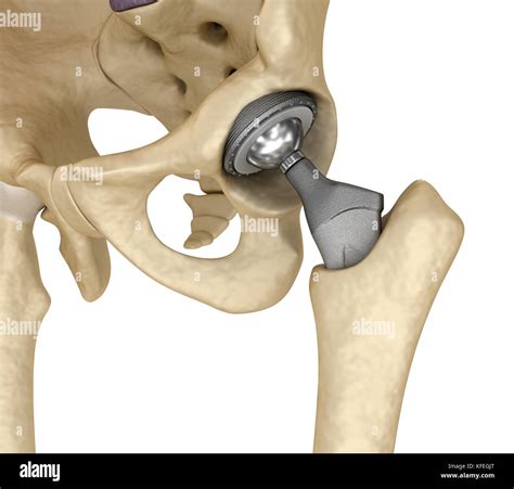 Titanium Hip Replacements At Sidney Hanna Blog