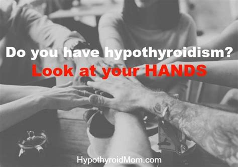 Do You Have Hypothyroidism Look At Your Hands Hypothyroid Mom