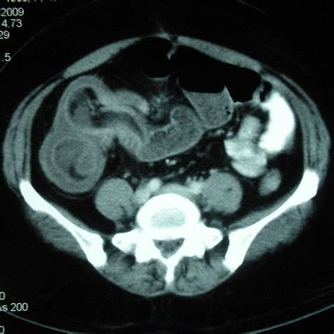 Symptoms And Signs Of Intussusception Download Scientific Diagram