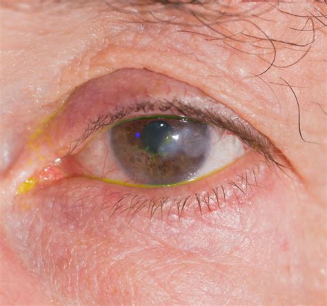 Herpes Keratitis Eye Patient