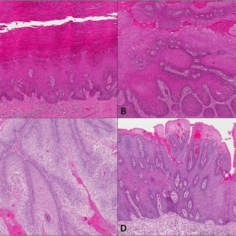 Devil And Synchronousmetachronous Verrucous Carcinoma Vulvar