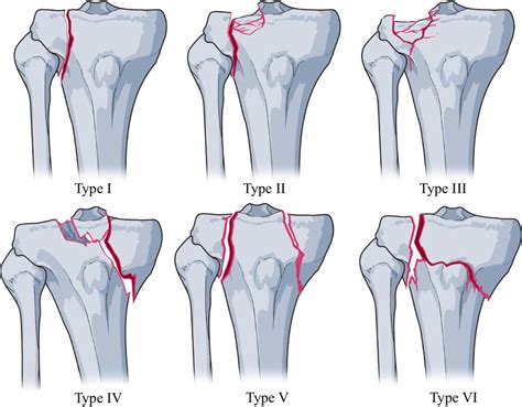 Schatzker Classification For Tibial Plateau Fractures Download Scientific Diagram