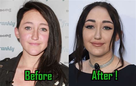 Noah Cyrus Excessive Plastic Surgery Before And After Celebritysurgeryicon