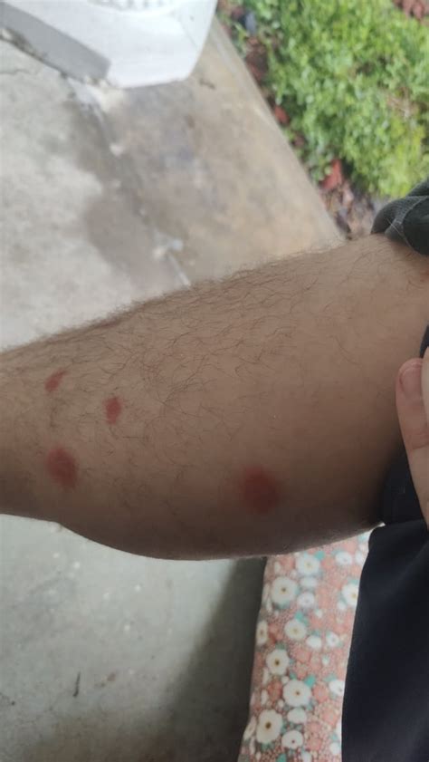 Large Red Flat Spots Not Itchy Appearing Everywhere On My Lower Body