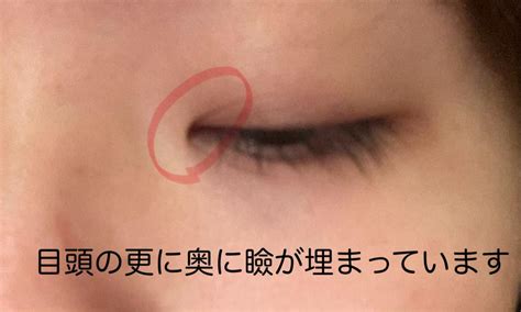 시술 수술 질문 쌍꺼풀 성형 눈시 강남언니 1등 성형수술and피부시술 정보앱
