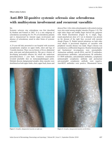 Pdf Anti Ro 52 Positive Systemic Sclerosis Sine Scleroderma With Multisystem Involvement And