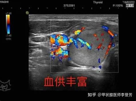 甲状腺血流信号丰富是什么意思 知乎