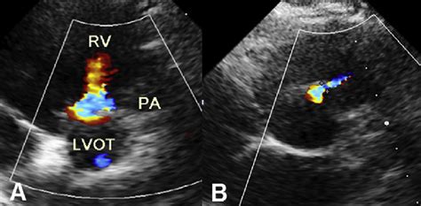 Subtype Of Subarterial Vsd Parasternal Short Axis View On Download Scientific Diagram