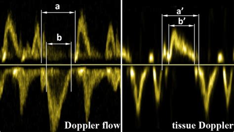 Myocardial Performance Index Measured By Two Methods 1 Doppler Flow Download Scientific