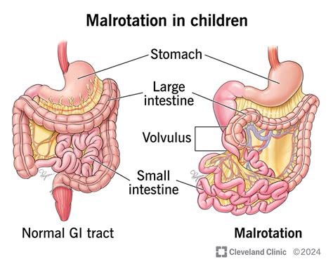 Volvulus Medical Term Sigmoid Volvulus Image