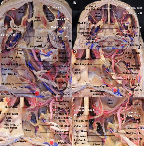 Pterygoid Plate Netter