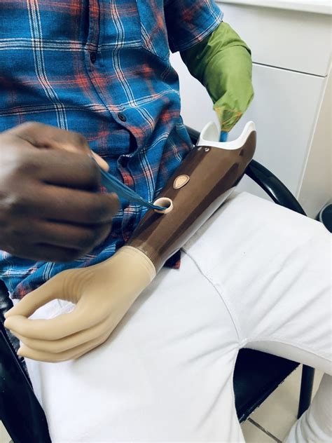 Upper Limb Prostheses Northcliff Orthopaedic Centre