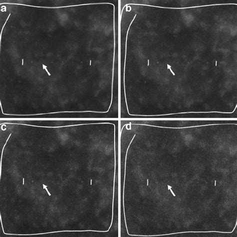 The Line Cluster Pattern Of Microcalcifications At The Four Dose Download Scientific Diagram
