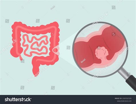 Colonoscopy Intestine Polypectomy Procedure Removal Polyp Stock Illustration 2197327335