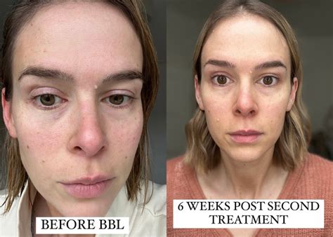 Bbl Laser Before And After Gurl Gone Green